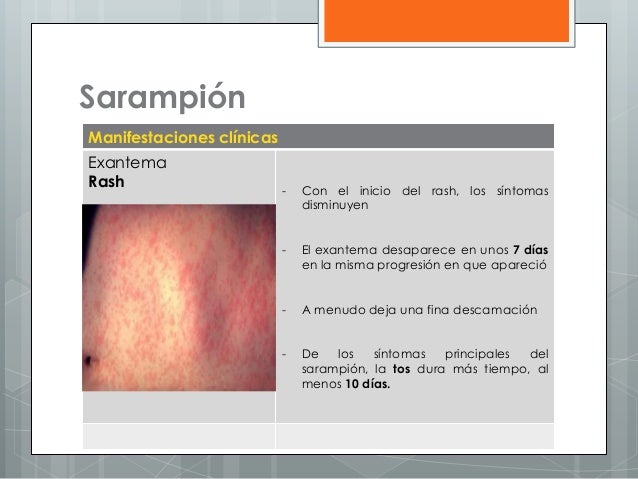 Sarampión