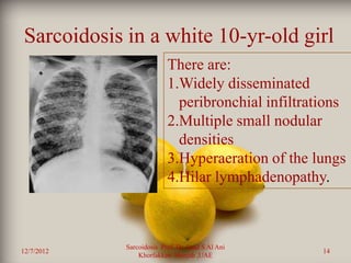 Sarcoidosis | PPTX
