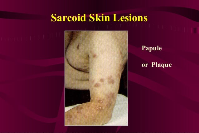 Sarcoidosis