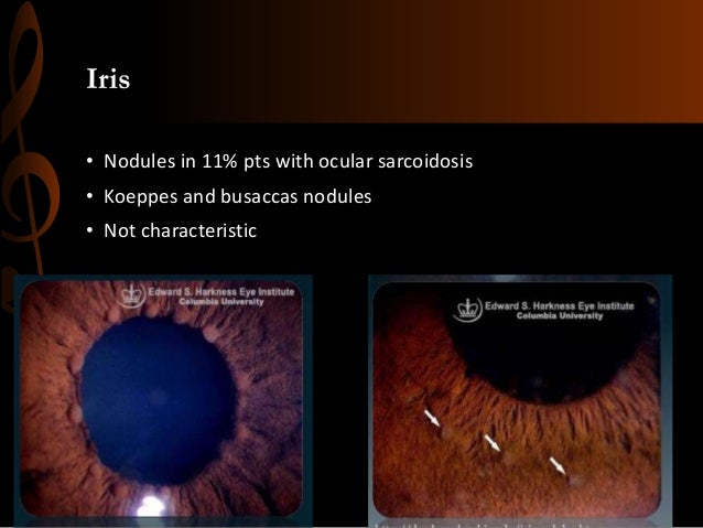 ocular Sarcoidosis