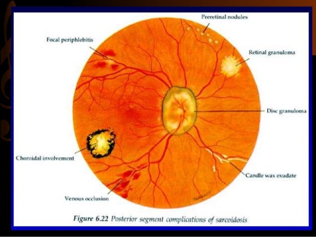 ocular Sarcoidosis