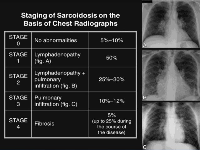 Sarcoidosis