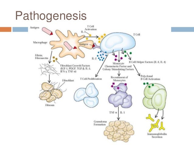 Sarcoidosis