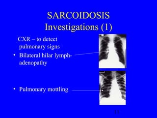 Sarcoidosis | PPT