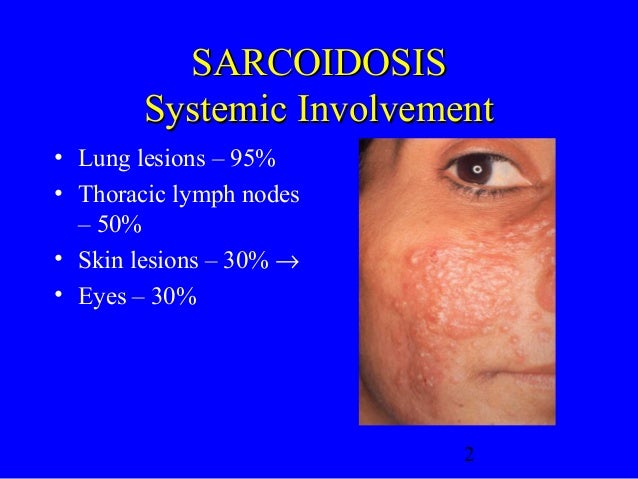Sarcoidosis