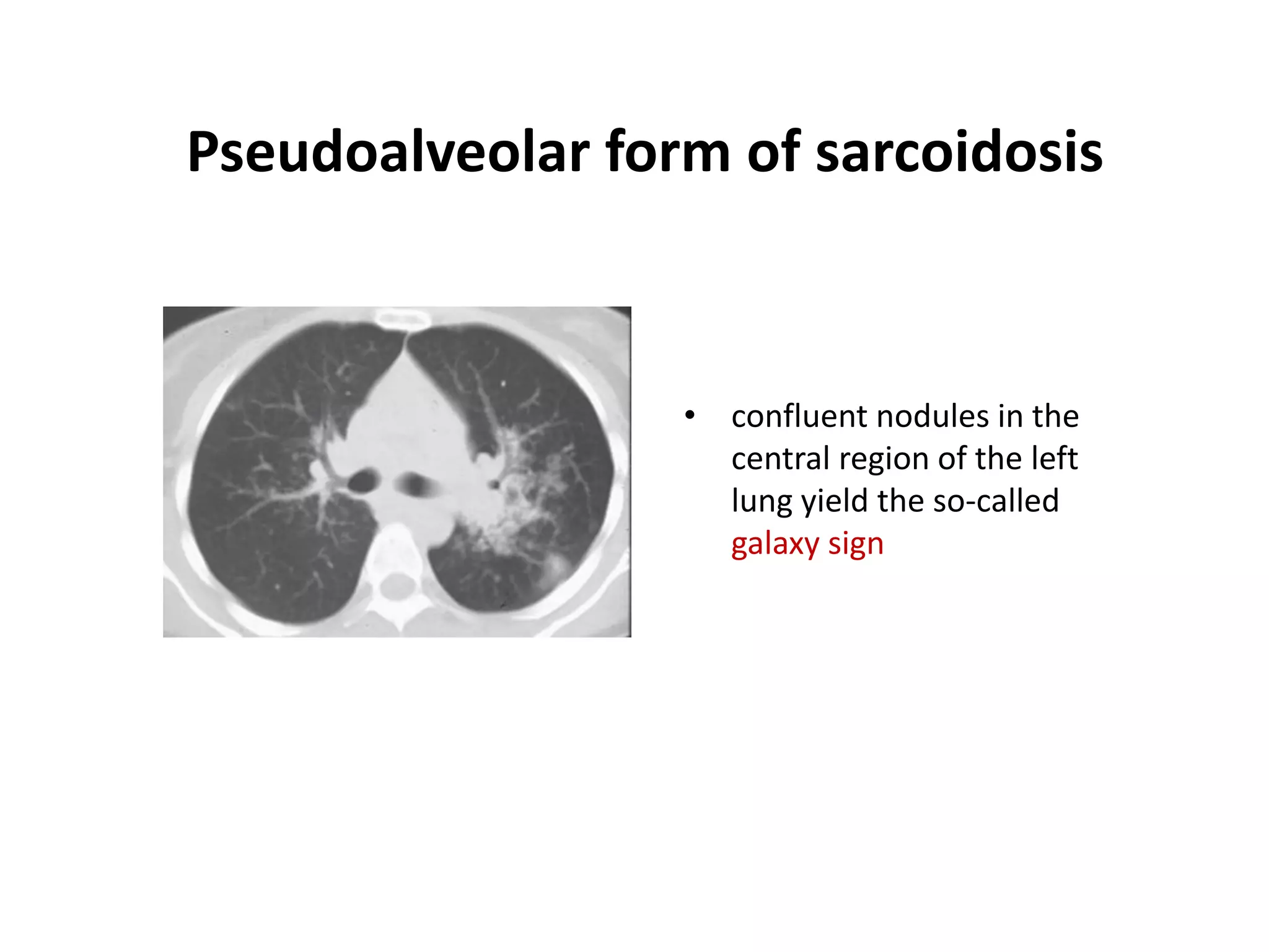 Pulmonary Sarcoidosis | PDF