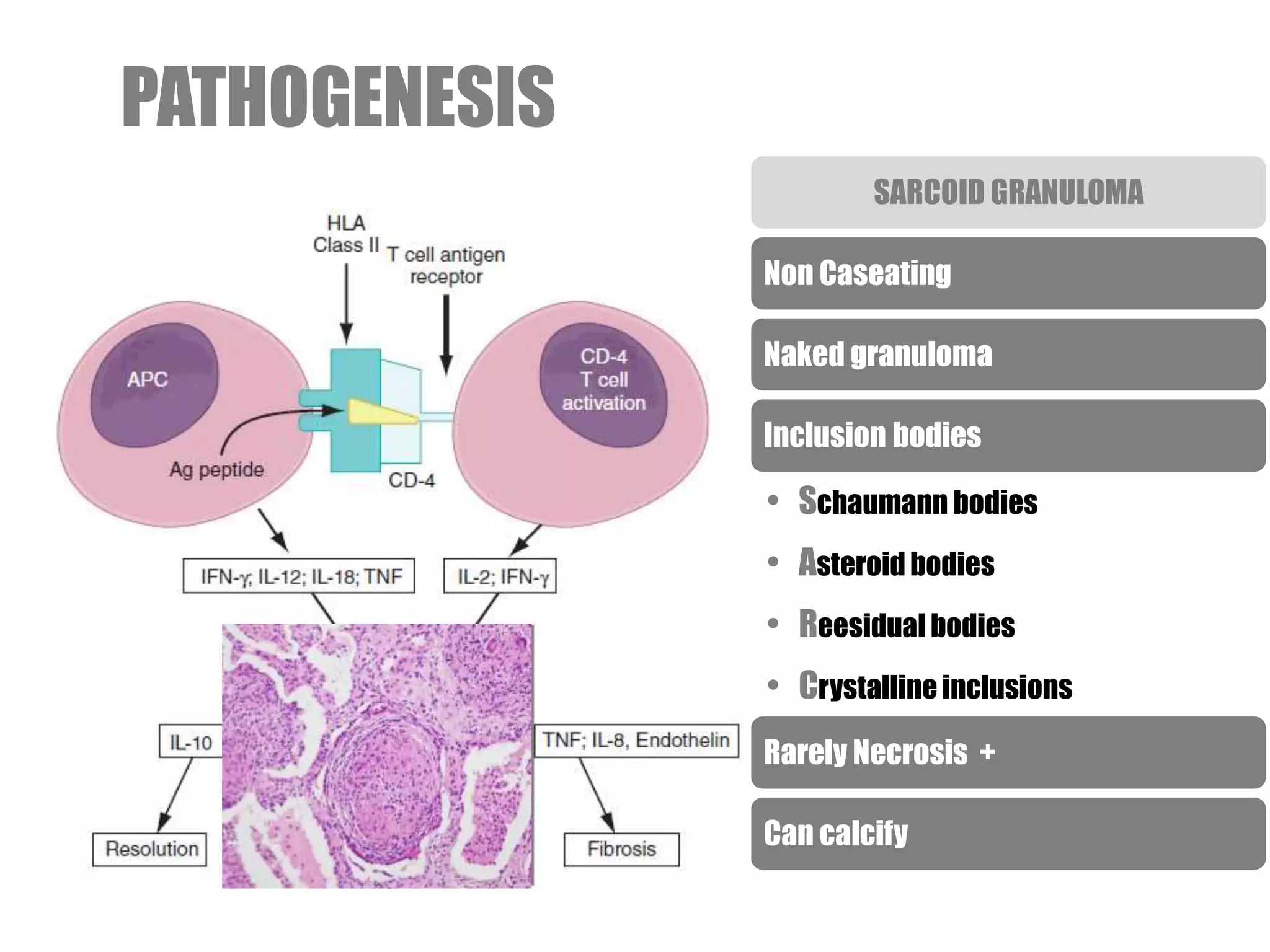 Sarcoidosis | PPTX