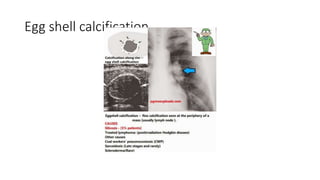Sarcoidosis revision notes | PDF