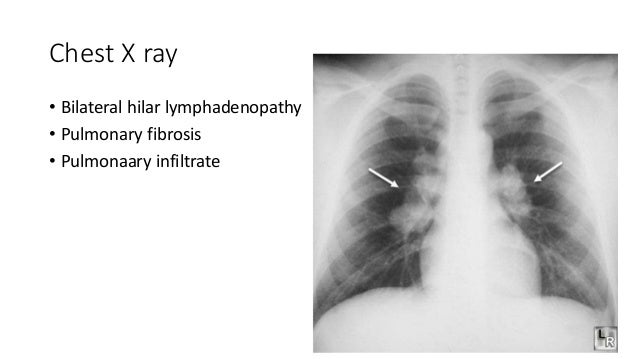 Sarcoidosis revision notes