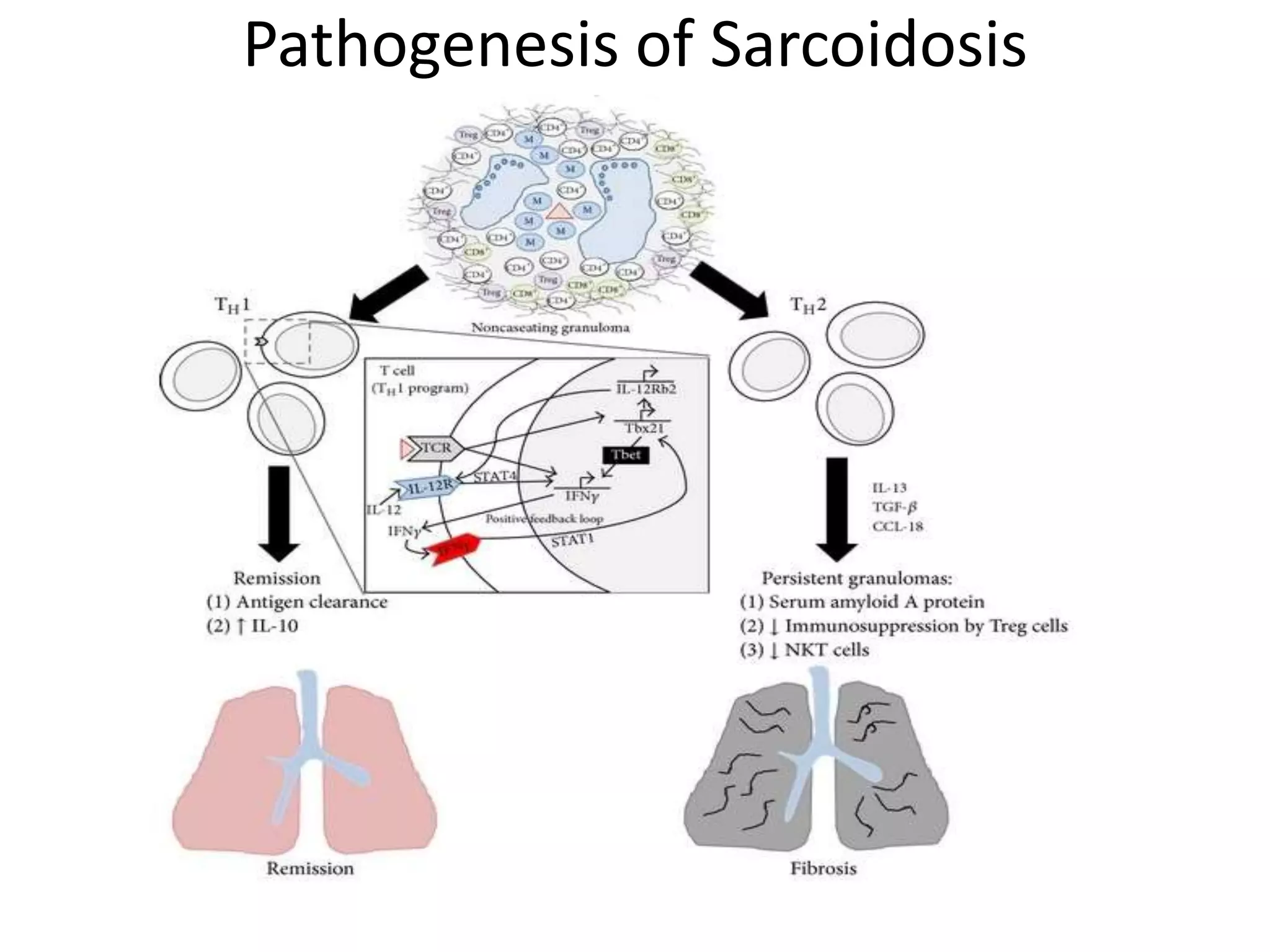Sarcoidosis | PPT