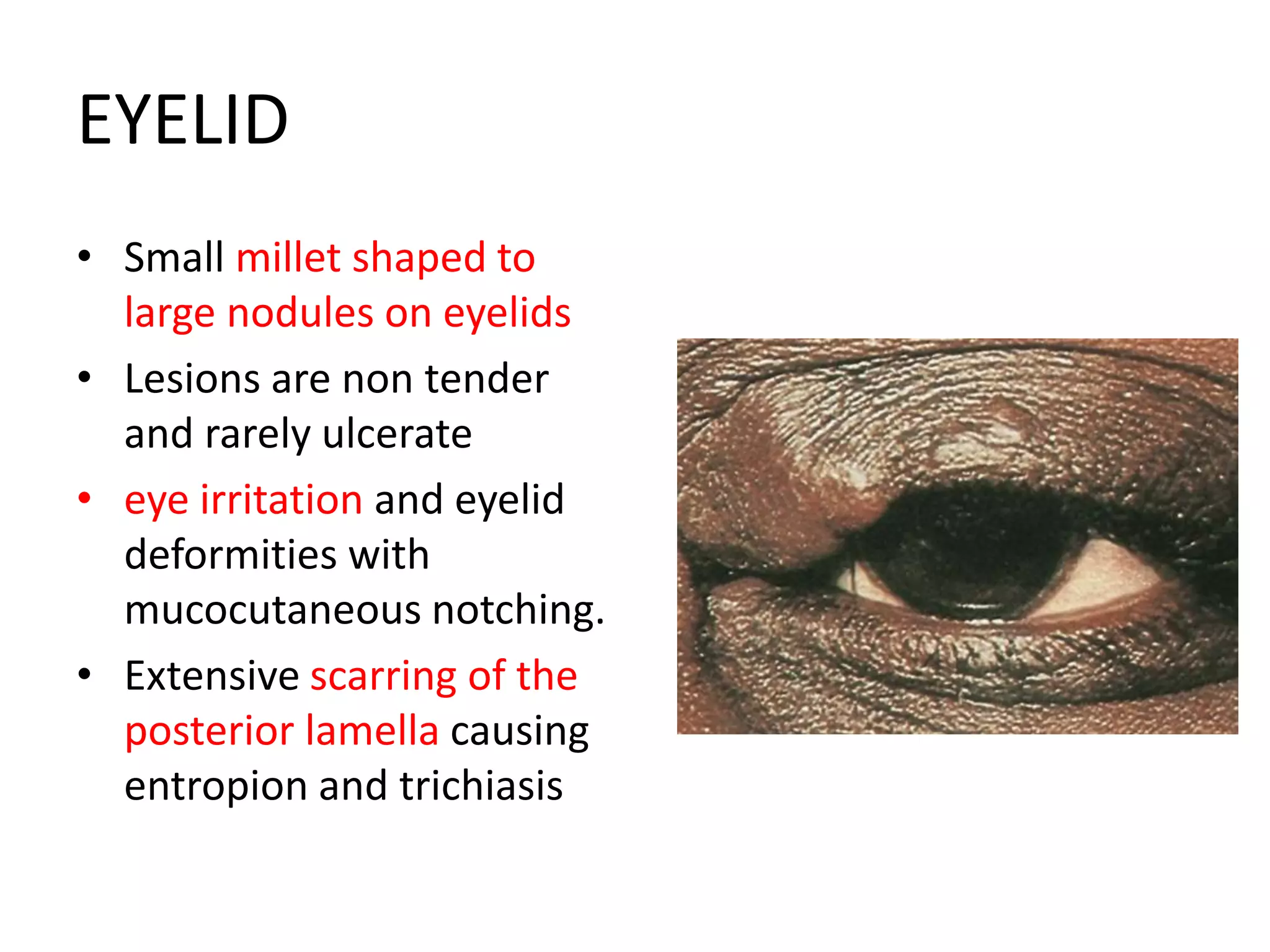 Sarcoidosis | PPTX