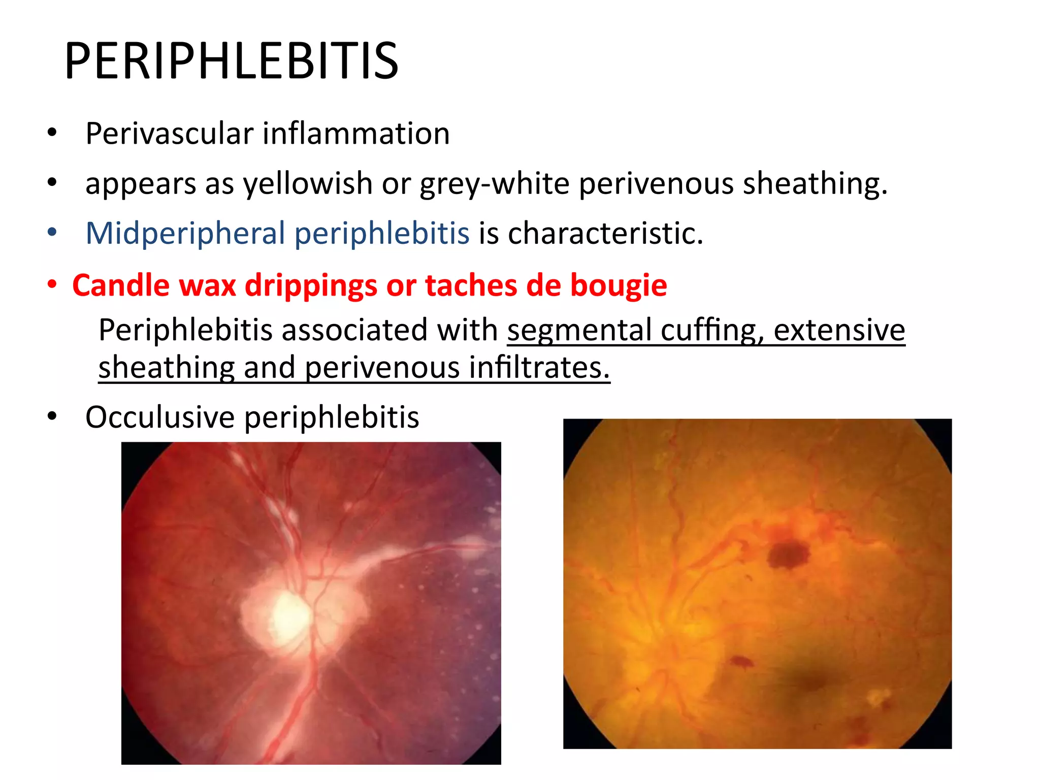 Sarcoidosis | PPTX