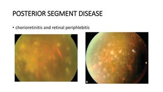 Sarcoidosis | PPTX