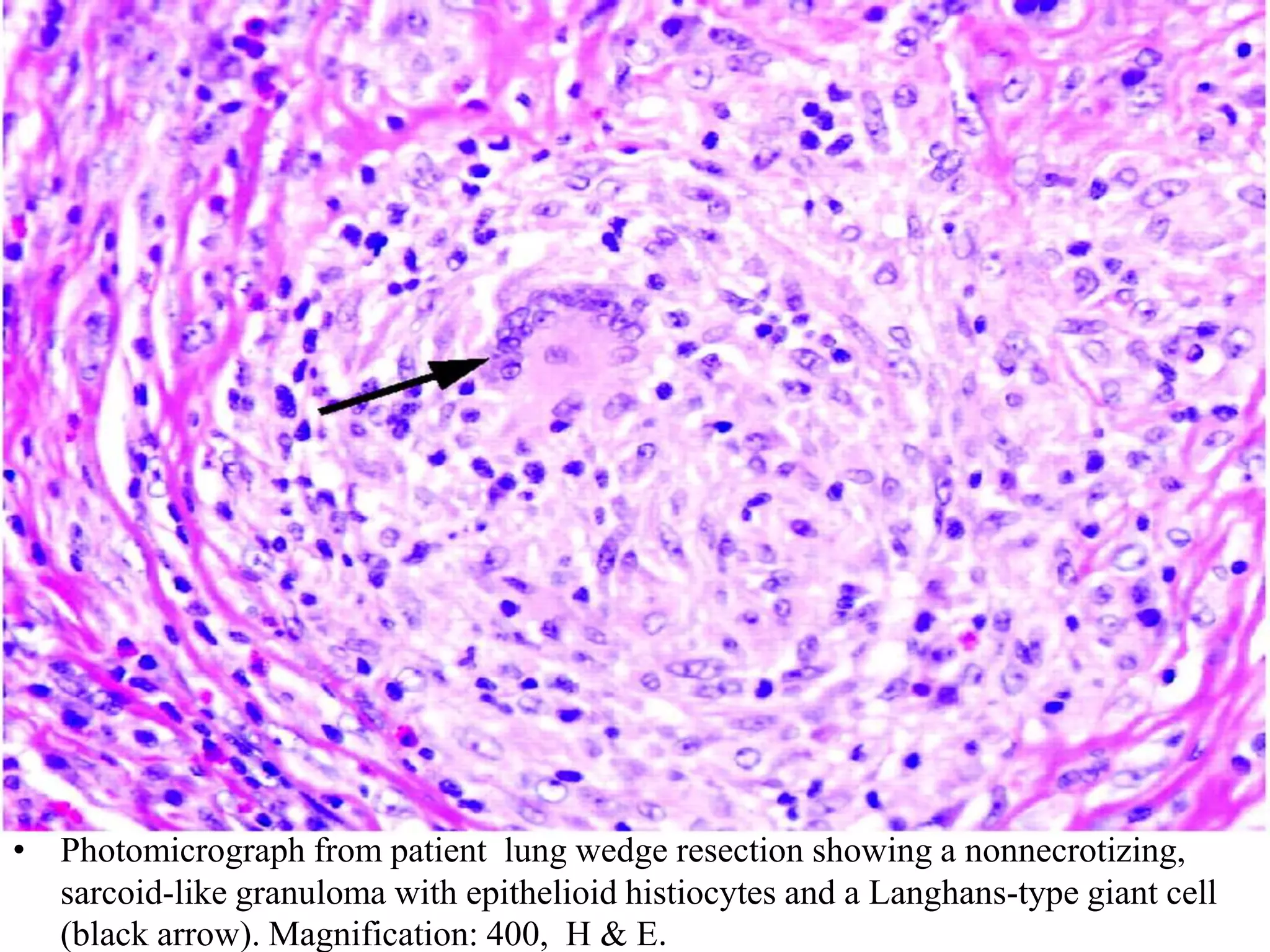 Sarcoidosis | PPT