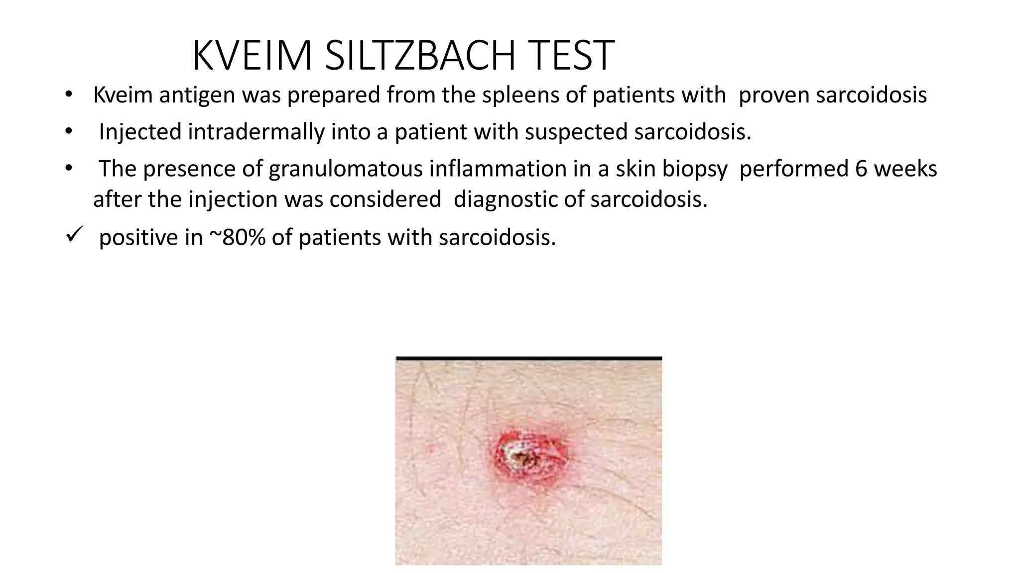 Sarcoidosis | PPTX