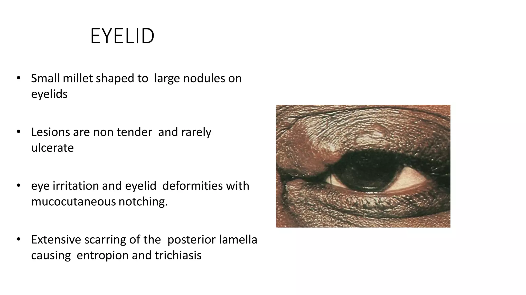 Sarcoidosis | PPTX