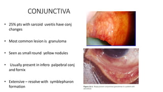 Sarcoidosis | PPTX | Eye and Vision Conditions | Diseases and Conditions