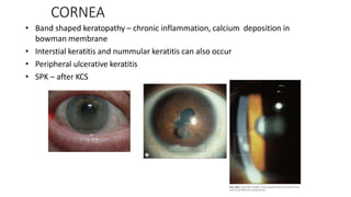 Sarcoidosis | PPTX | Eye and Vision Conditions | Diseases and Conditions
