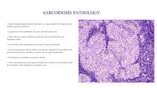 Sarcoidosis .pptx