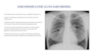 Sarcoidosis .pptx