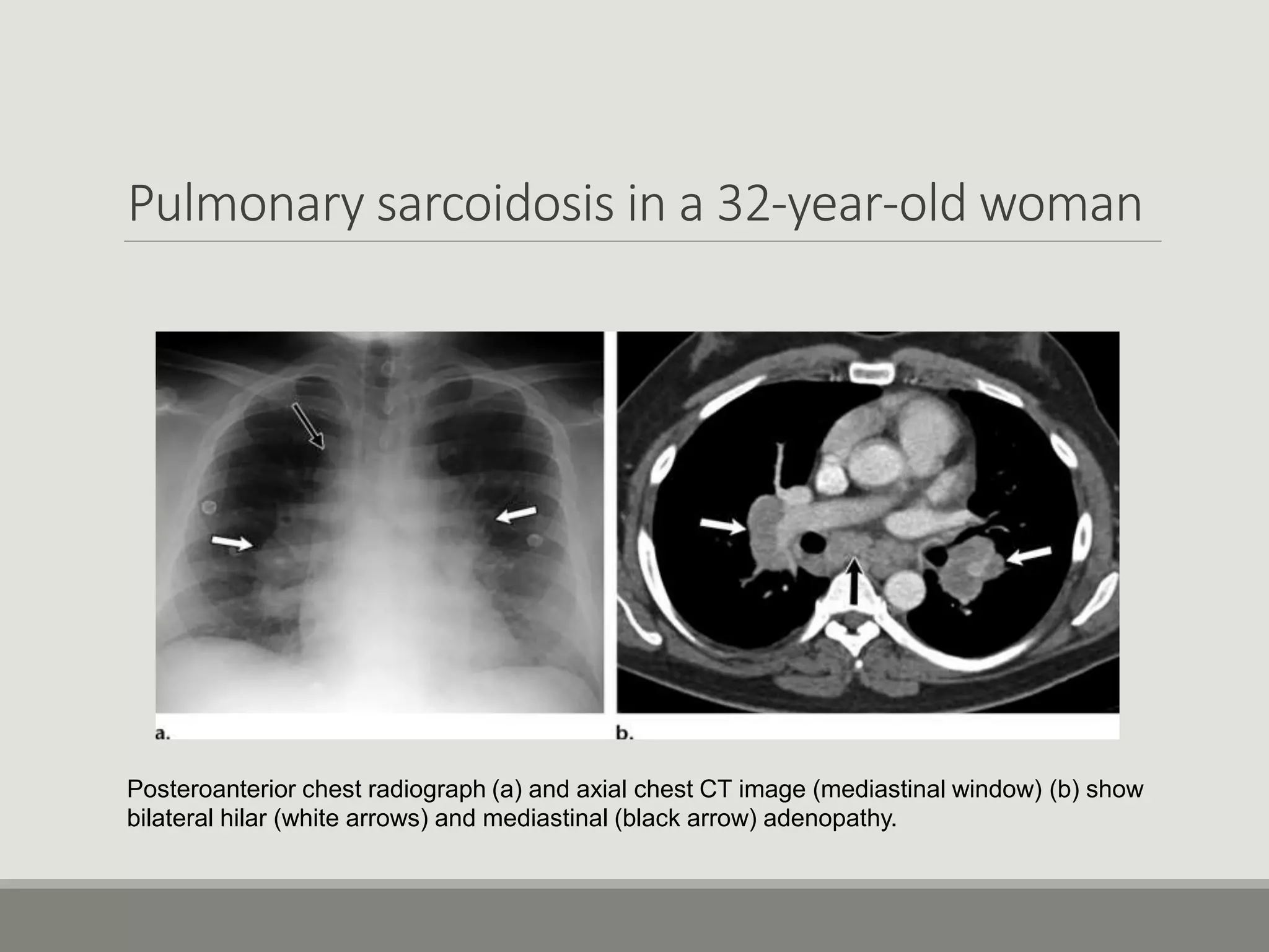 Sarcoidosis from head to toe: What the radiologist needs to know | PPTX