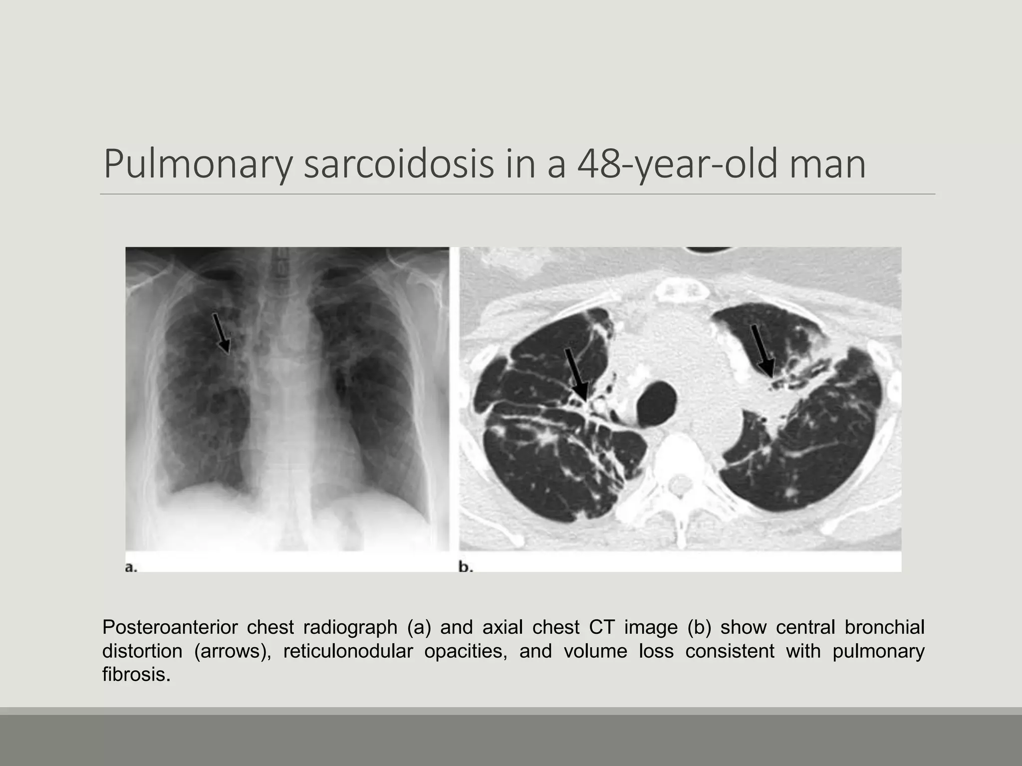 Sarcoidosis from head to toe: What the radiologist needs to know | PPTX