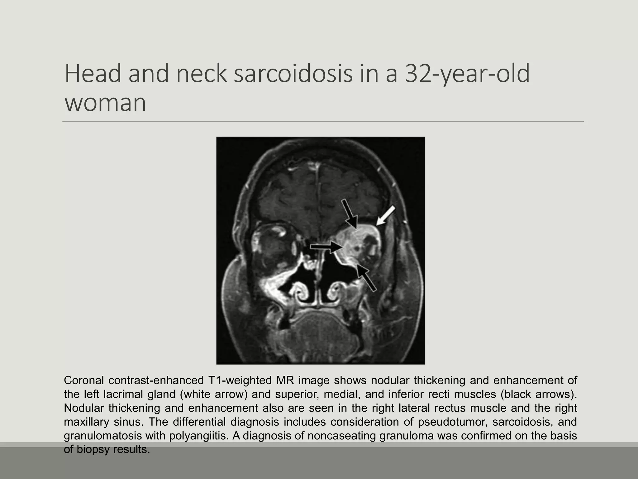 Sarcoidosis from head to toe: What the radiologist needs to know | PPTX