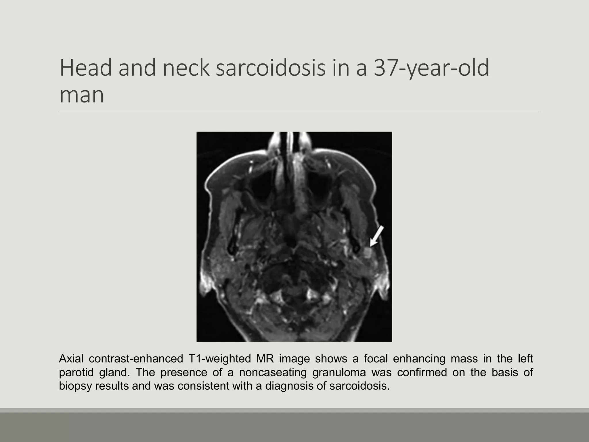 Sarcoidosis from head to toe: What the radiologist needs to know | PPTX