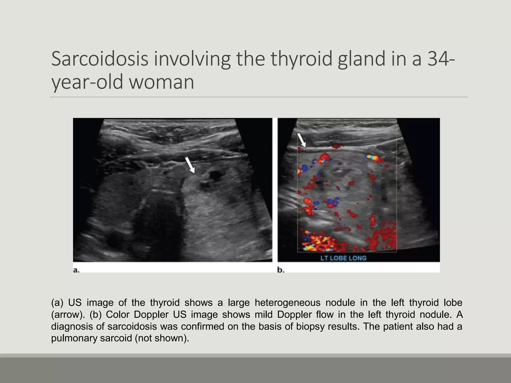 Sarcoidosis from head to toe: What the radiologist needs to know | PPTX