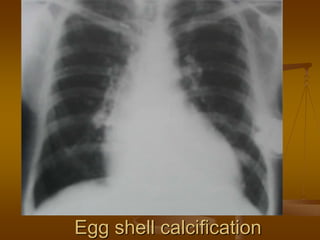 Sarcoidosis radiology pulmonary neuro abdominal .ppt | Lung and Respiratory Health | Diseases ...