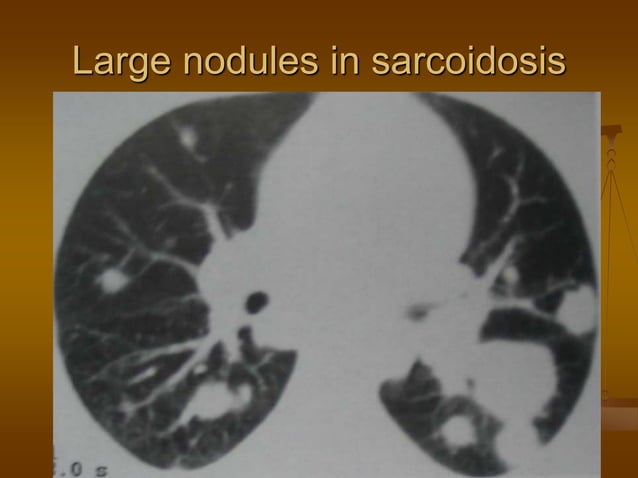 Sarcoidosis radiology pulmonary neuro abdominal .ppt
