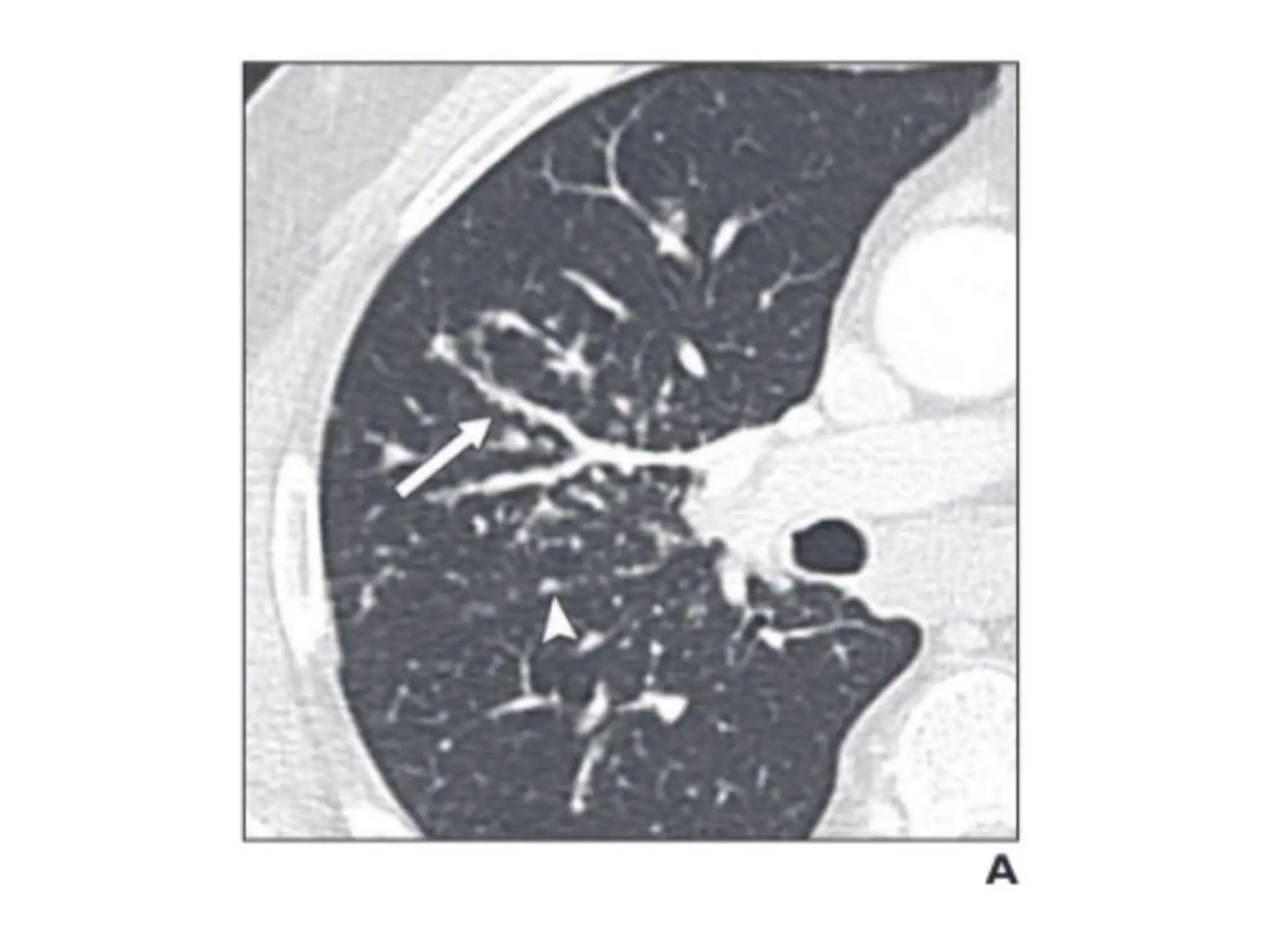sarcoidosis chest xray and hrct findings | PPTX
