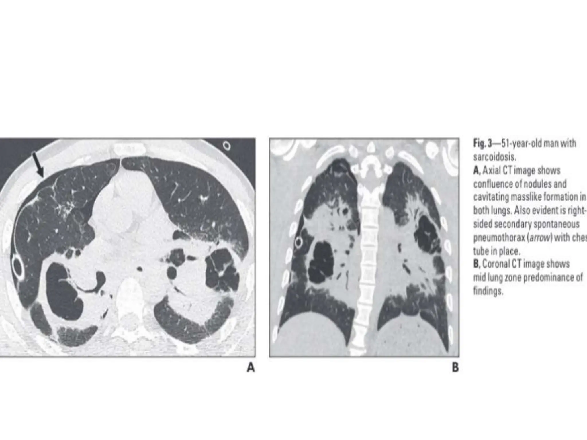 sarcoidosis chest xray and hrct findings | PPTX