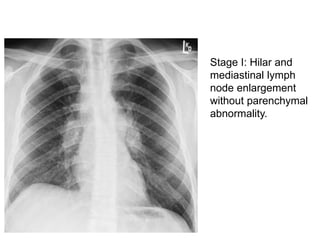 sarcoidosis chest xray and hrct findings | PPTX