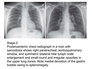 sarcoidosis chest xray and hrct findings | PPTX