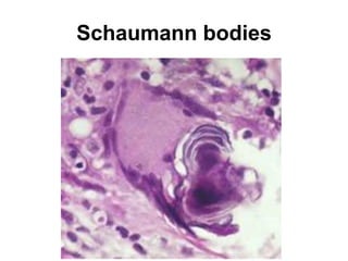 Sarcoidosis | PDF