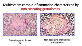 Sarcoidosis | PPTX