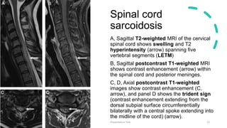 Sarcoidosis and the Nervous System.pptx