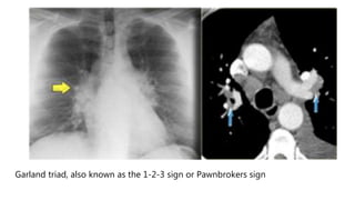 Sarcoidosis imaging | PPT