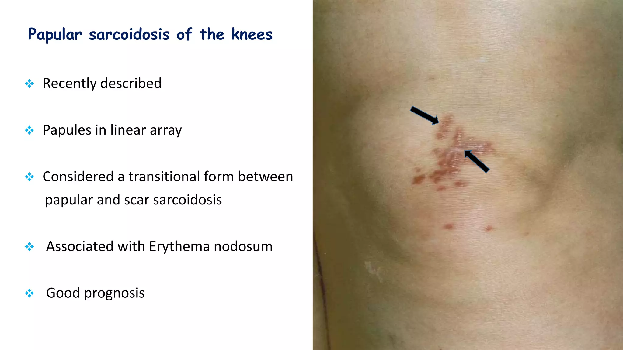Cutaneous Sarcoidosis, Sarcoidosis, Approach to cutaneous sarcoidosis ...