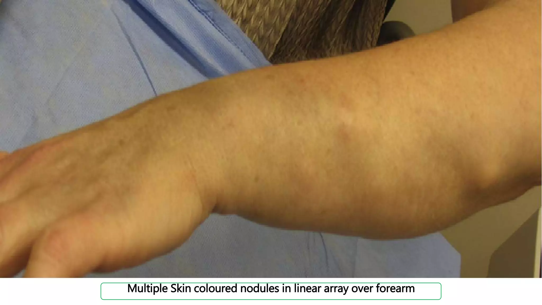 Cutaneous Sarcoidosis, Sarcoidosis, Approach to cutaneous sarcoidosis ...