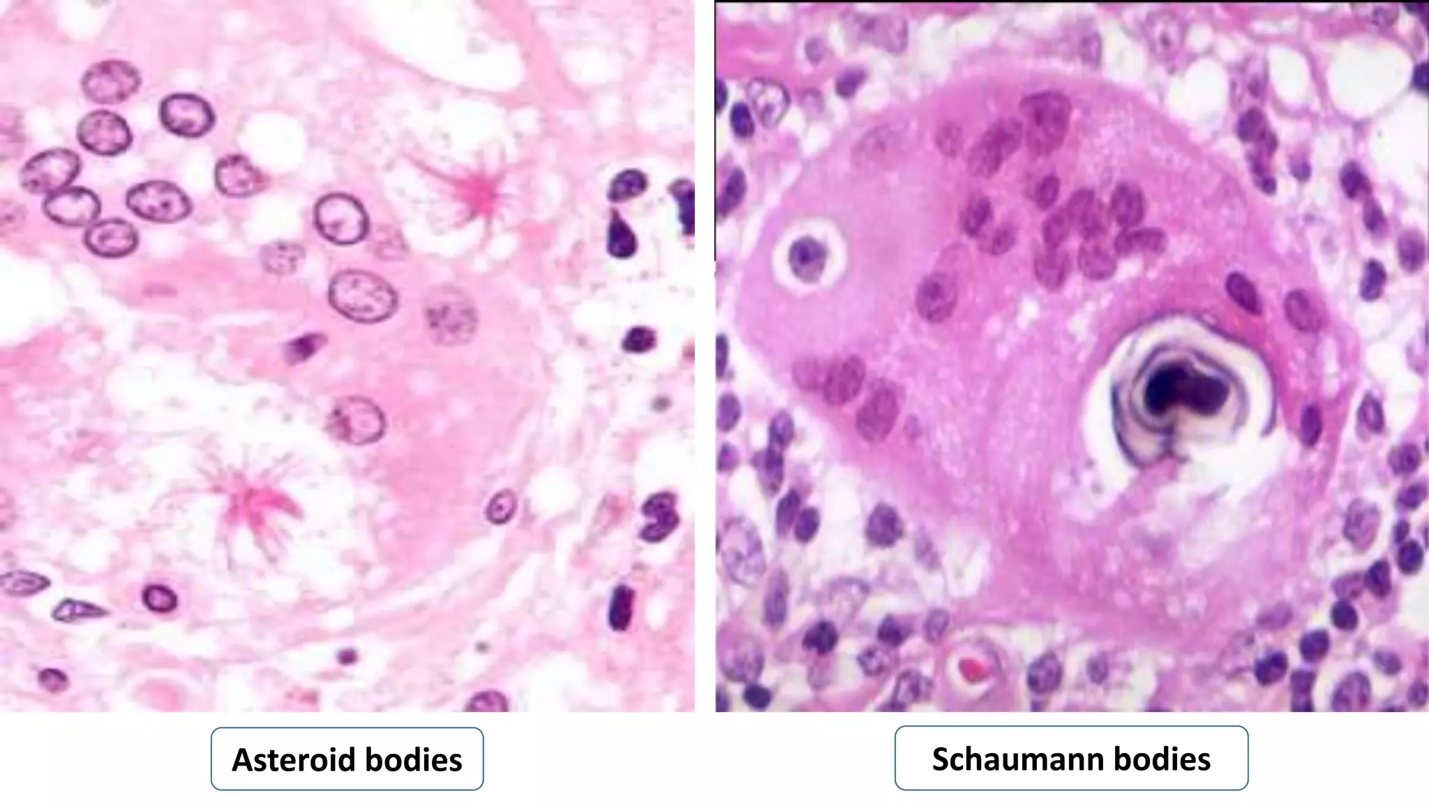 Cutaneous Sarcoidosis, Sarcoidosis, Approach to cutaneous sarcoidosis ...
