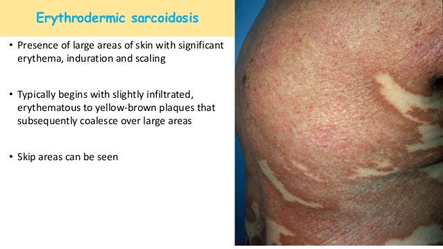 Cutaneous Sarcoidosis, Sarcoidosis, Approach to cutaneous sarcoidosis…