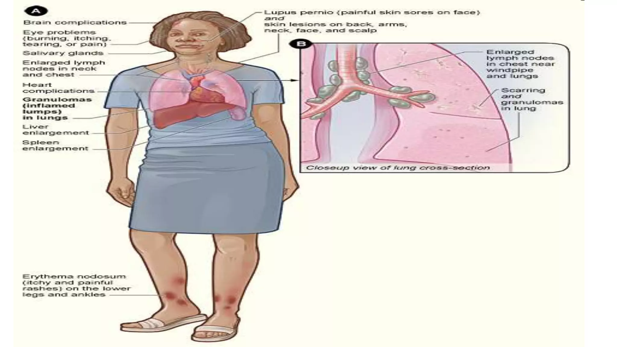 Sarcoidosis Complete | PPT