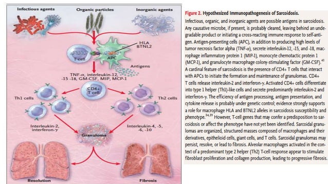 Sarcoidosis Complete | PPT