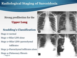 Sarcoidosis Lung Stages