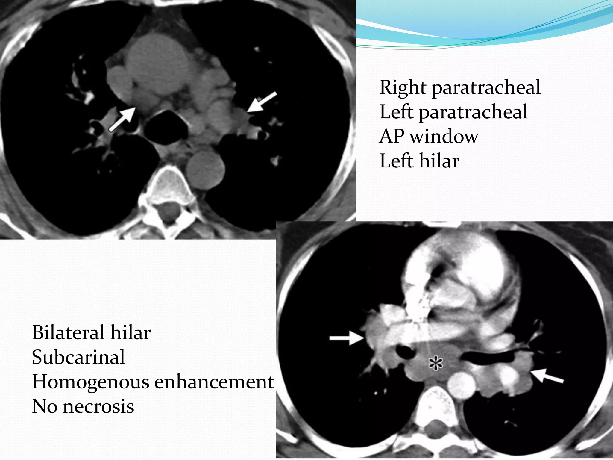 IMAGING IN SARCOIDOSIS | PPTX