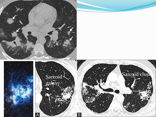 IMAGING IN SARCOIDOSIS | PPTX