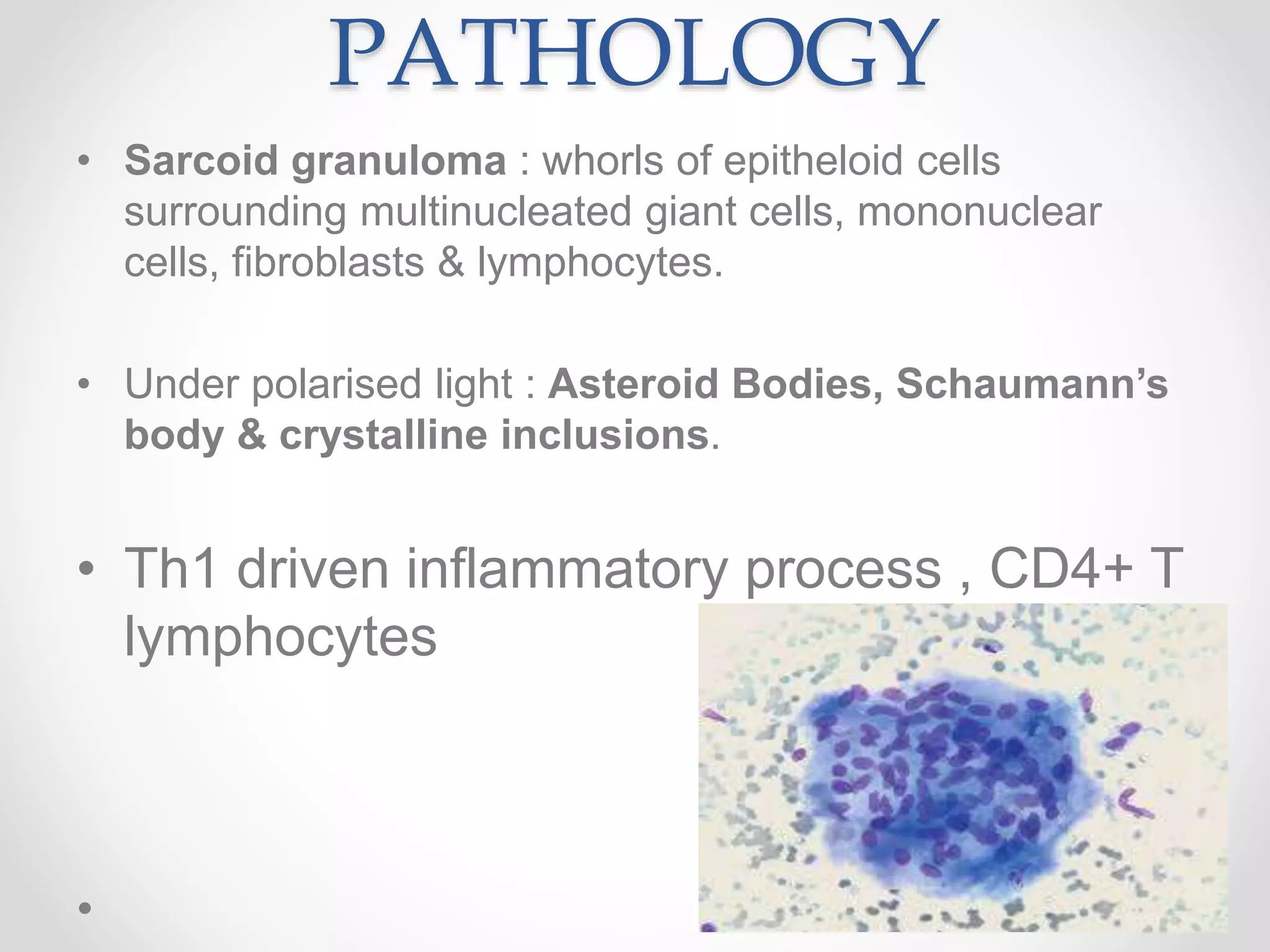Sarcoidotic uveitis | PPTX