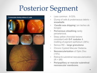 Sarcoidotic uveitis | PPTX
